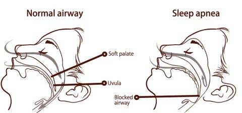 Sleep Apnea in Children | Paulson Orthodontics | Redlands CA